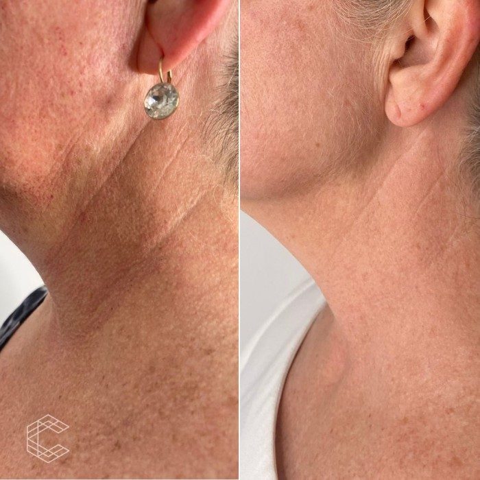 Complete Skin and Beauty - Plasma Fibroblast Therapy