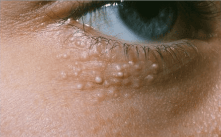 Complete Skin and Beauty - Milia - Causes and Treatment