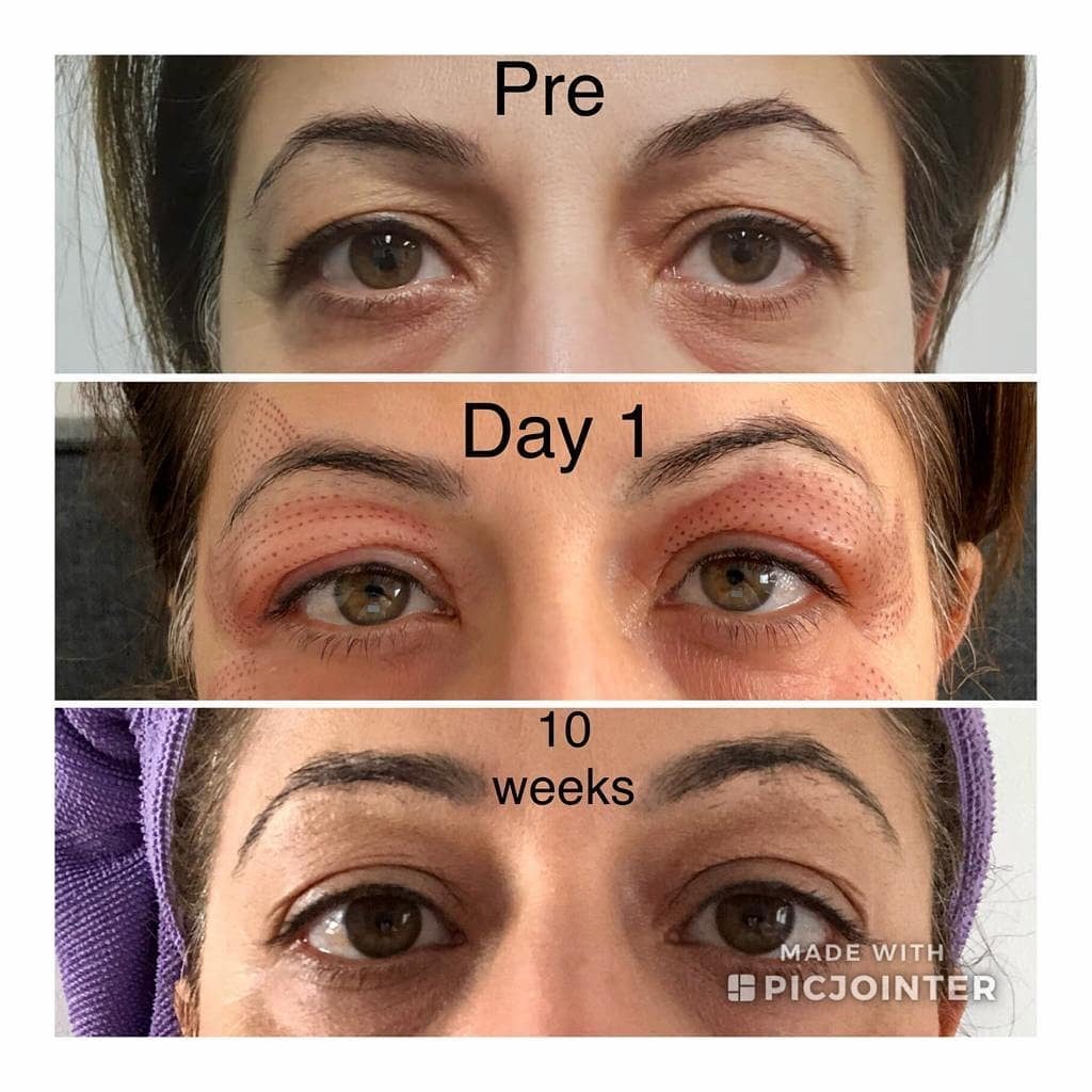 Non Surgical Lifting And Skin Tightening Plasma Pen Fibroblast